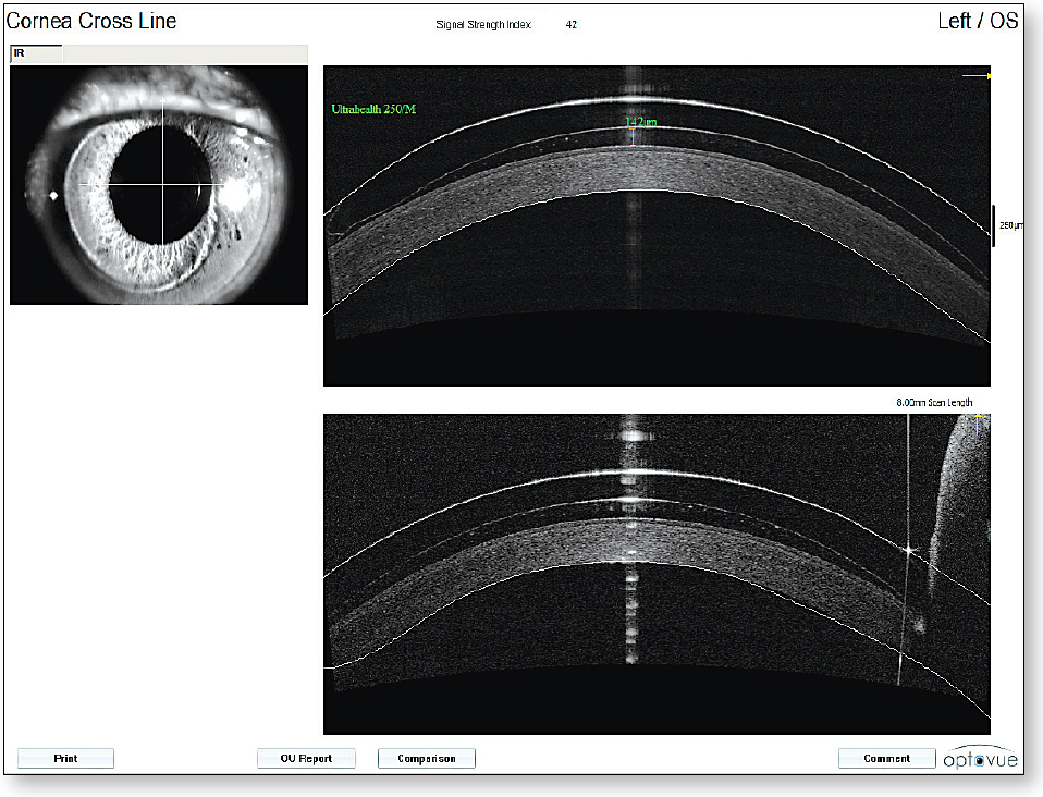 Contact Lens Spectrum | PentaVision