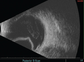 Contact Lens Spectrum | PentaVision