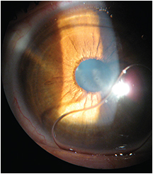 Contact Lens Spectrum | PentaVision