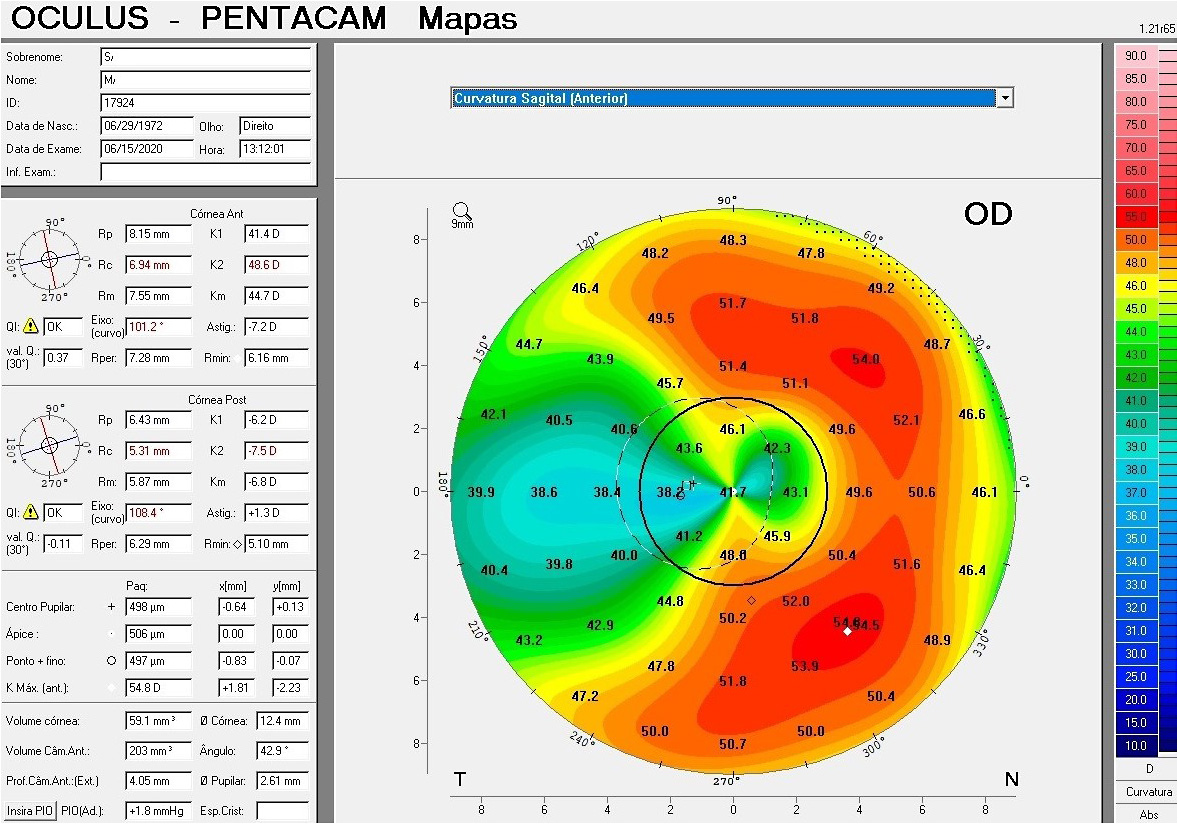Contact Lens Spectrum | PentaVision