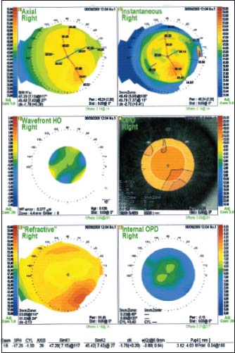 Contact Lens Spectrum | PentaVision