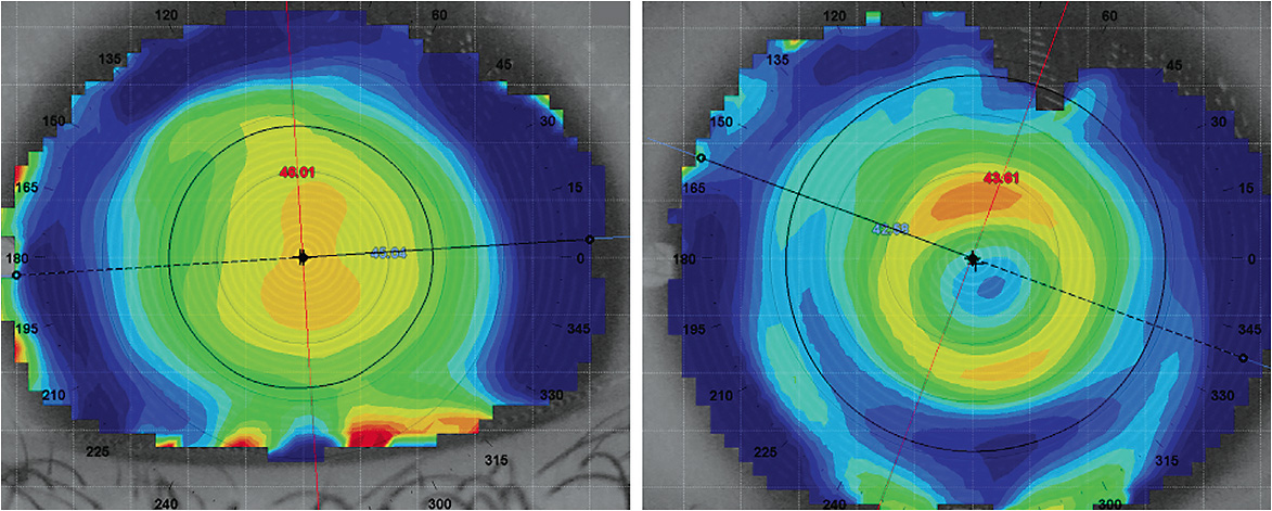 Contact Lens Spectrum | PentaVision