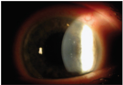 Contact Lens Spectrum | PentaVision