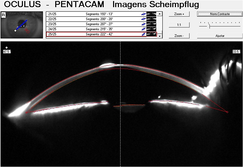 Contact Lens Spectrum | PentaVision