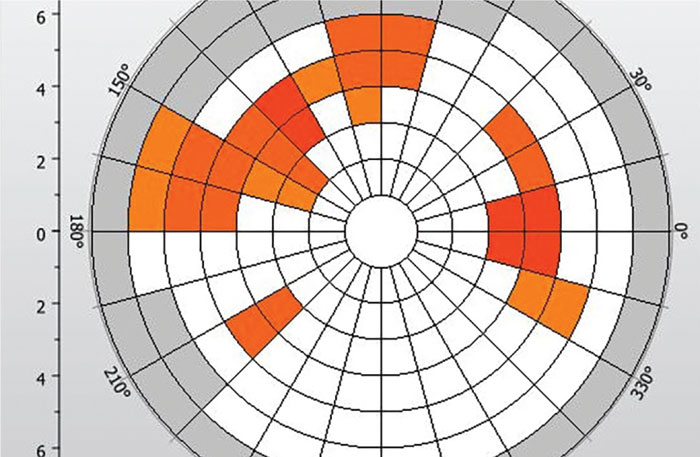 DRY EYE DX AND TX | Contact Lens Spectrum