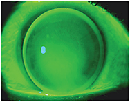 Contact Lens Spectrum | PentaVision