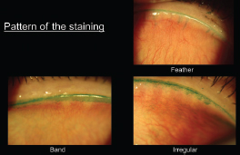 Contact Lens Spectrum | PentaVision