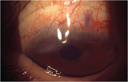 Contact Lens Spectrum | PentaVision