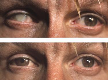 Contact Lens Spectrum | PentaVision