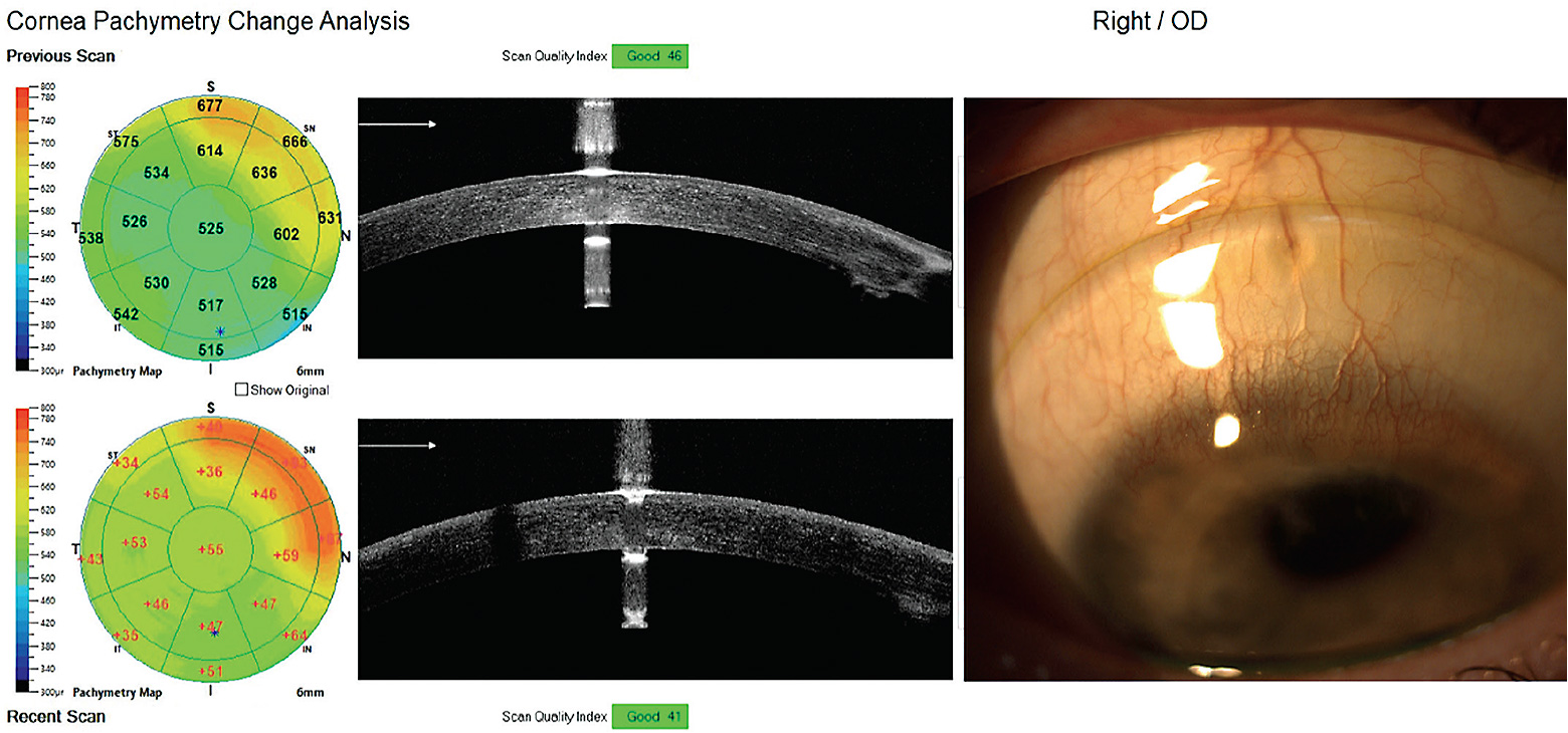 Contact Lens Spectrum | PentaVision