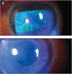 Contact Lens Spectrum | PentaVision