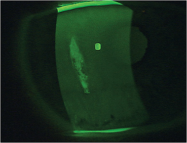 Contact Lens Spectrum | PentaVision