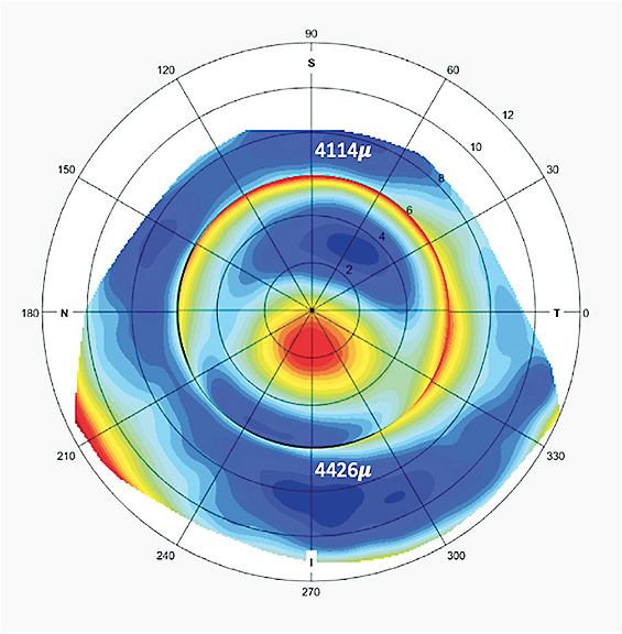 Contact Lens Spectrum | PentaVision