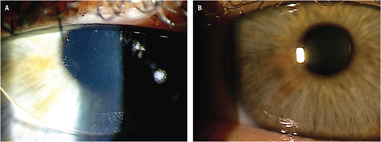 Contact Lens Spectrum | PentaVision