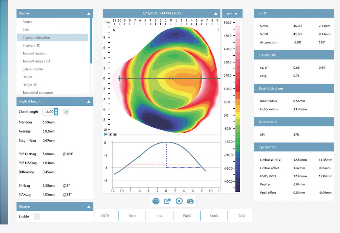 Contact Lens Spectrum | PentaVision