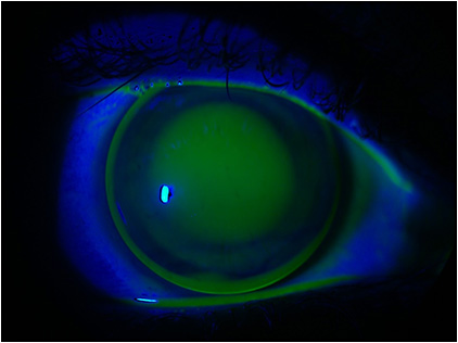 Contact Lens Spectrum | PentaVision