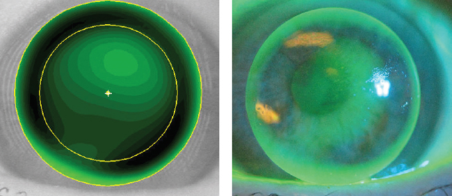 Contact Lens Spectrum | PentaVision