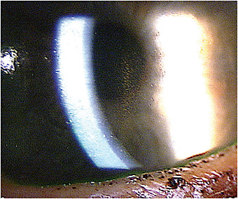 Contact Lens Spectrum | PentaVision