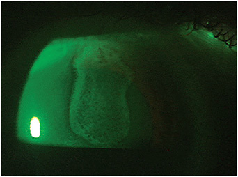 Contact Lens Spectrum | PentaVision