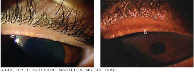 Contact Lens Spectrum | PentaVision