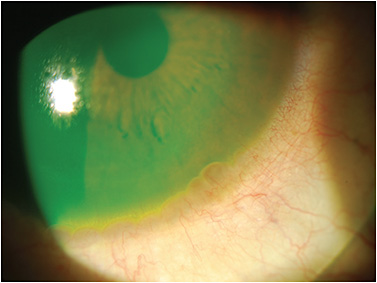 Contact Lens Spectrum | PentaVision