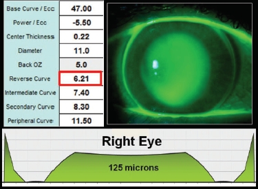 Contact Lens Spectrum | PentaVision