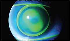 Contact Lens Spectrum | PentaVision