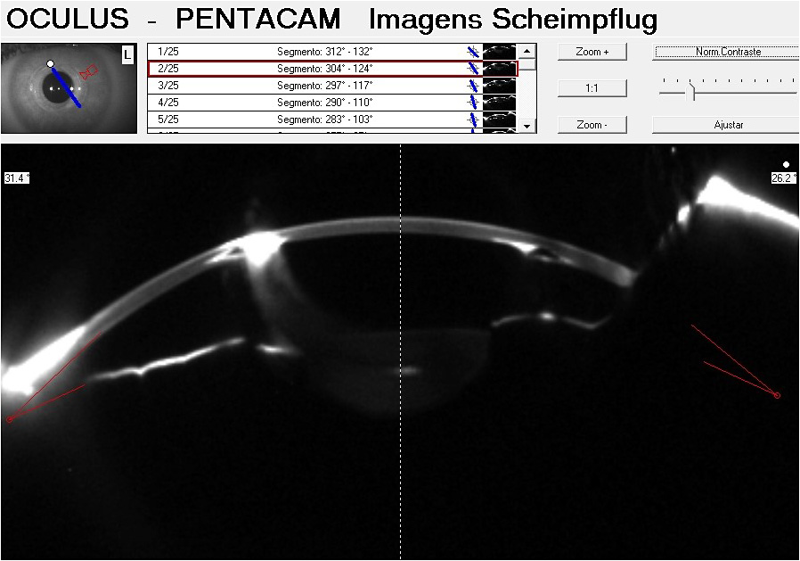 Contact Lens Spectrum | PentaVision