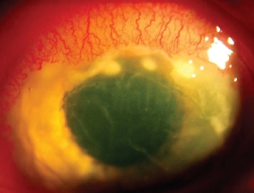 Contact Lens Spectrum | PentaVision